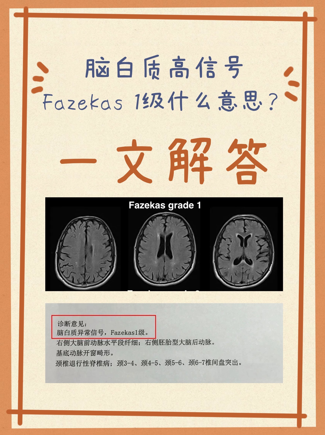 脑白质高信号Fazekas 1级什么意思？一文解答-有来医生