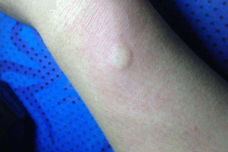 PPD检测正常和不正常图_有来医生